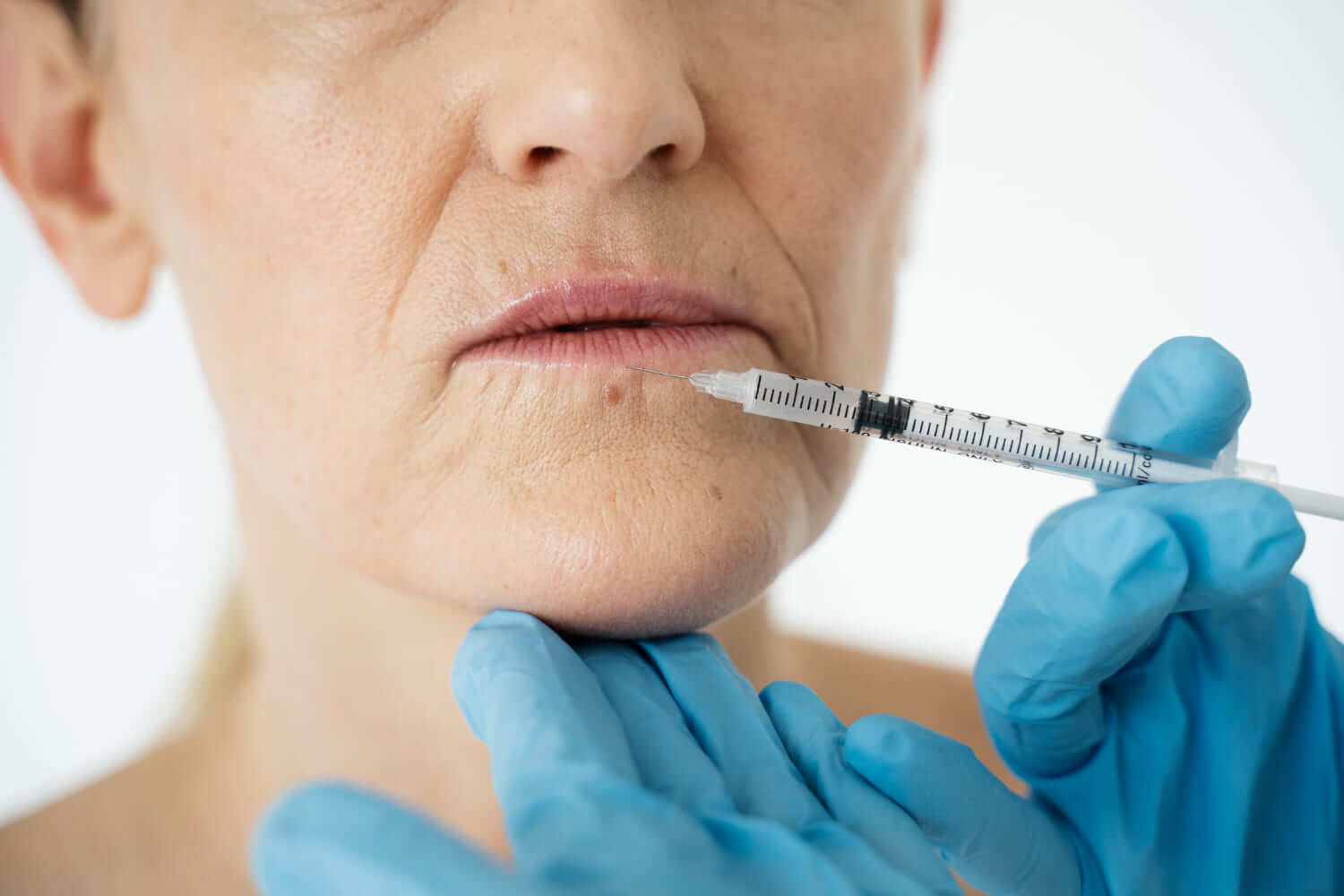 Rugas Periorais: Tratamentos para o "código de barras", as rugas ao ...