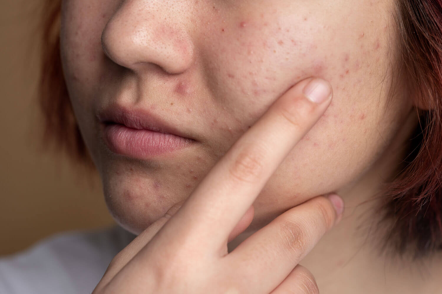 Acne infantil: 7 dicas para fazer limpeza de pele em crianças ...